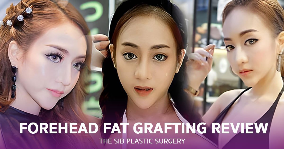 Forehead Fat Grafting: 3 Reasons It’s Gaining Popularity