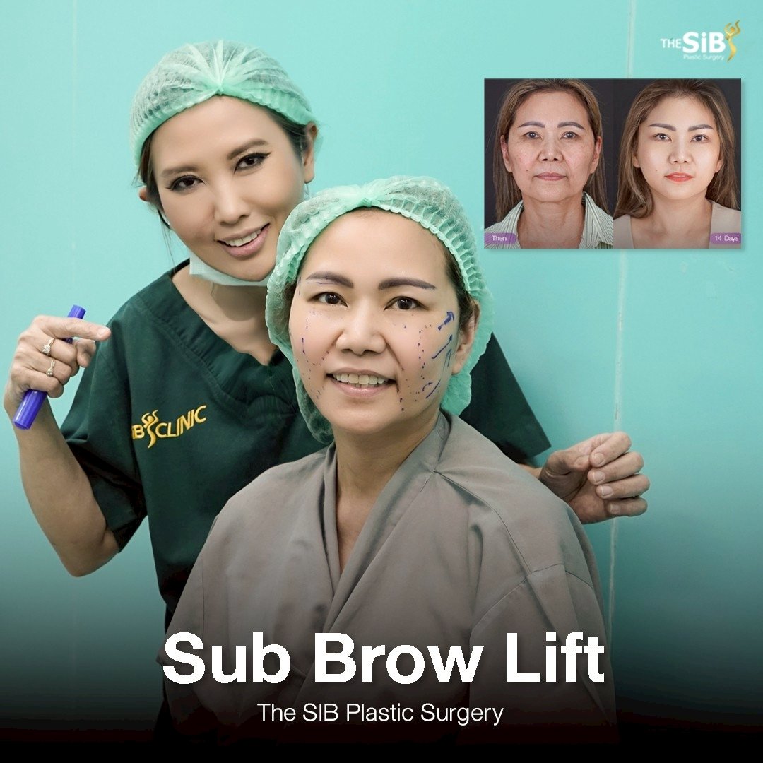 Sub-Brow Lift – The SIB Plastic Surgery