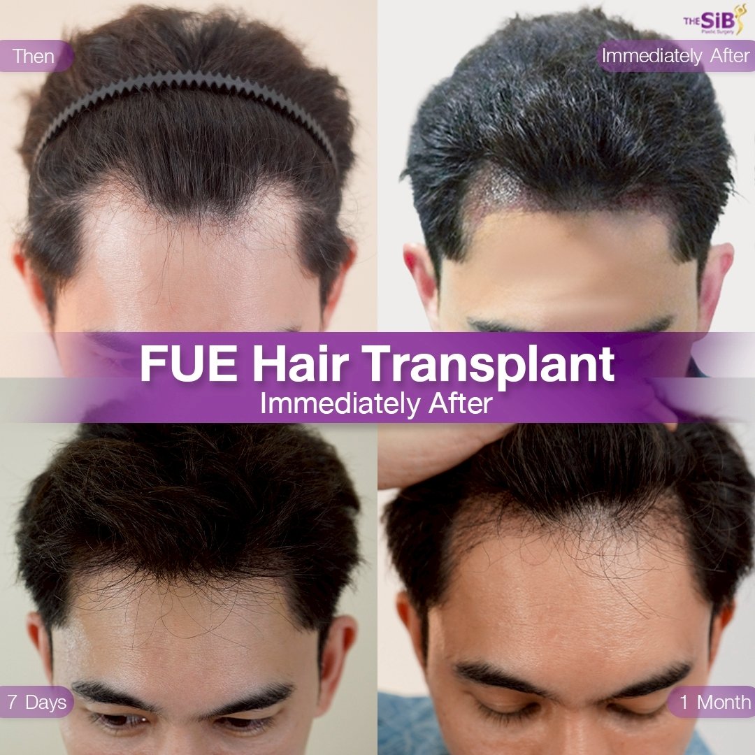 Lower Hairline Surgery – The SIB Plastic Surgery