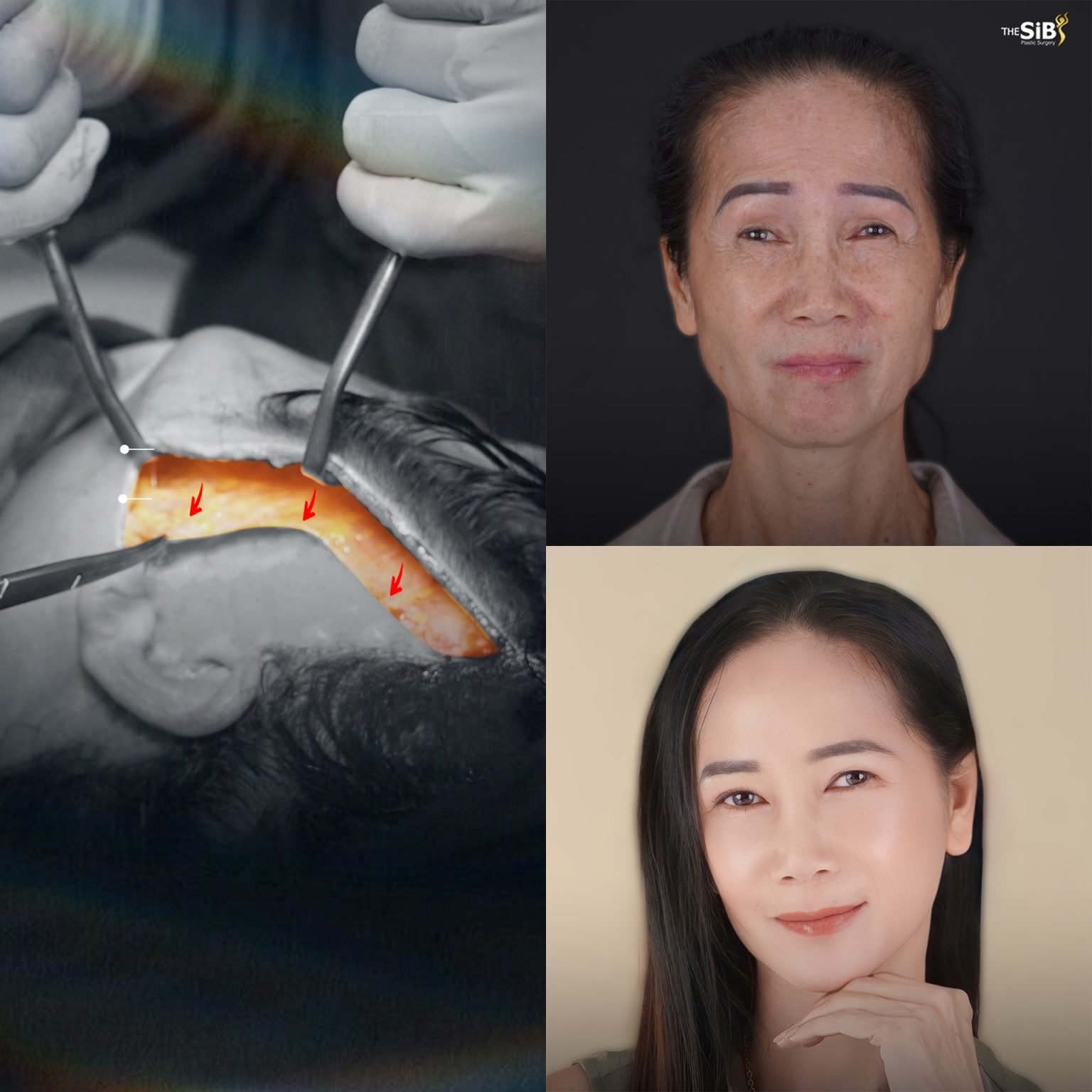 Full Face Lift – The SIB Plastic Surgery