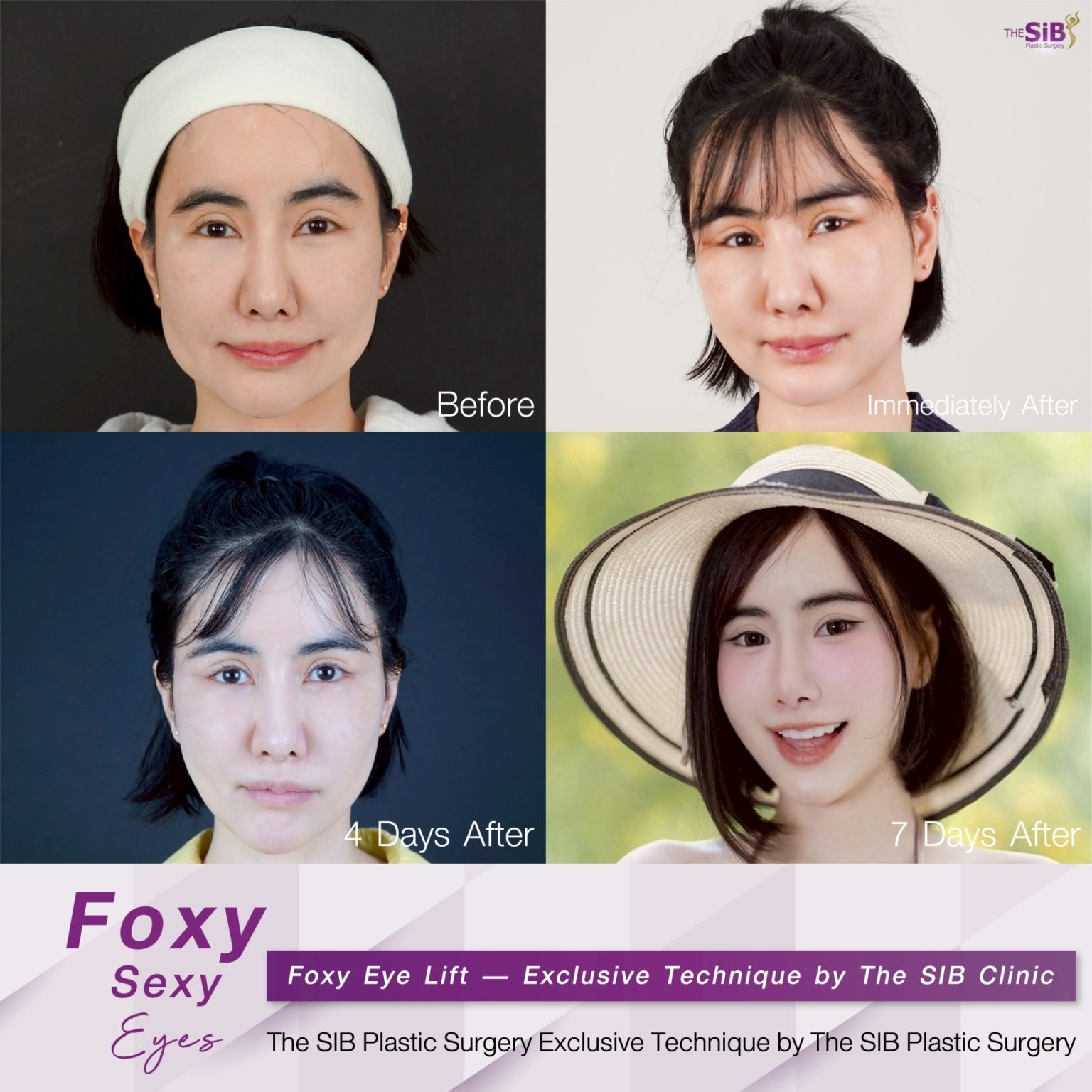 Foxy Sexy Eye – The SIB Plastic Surgery