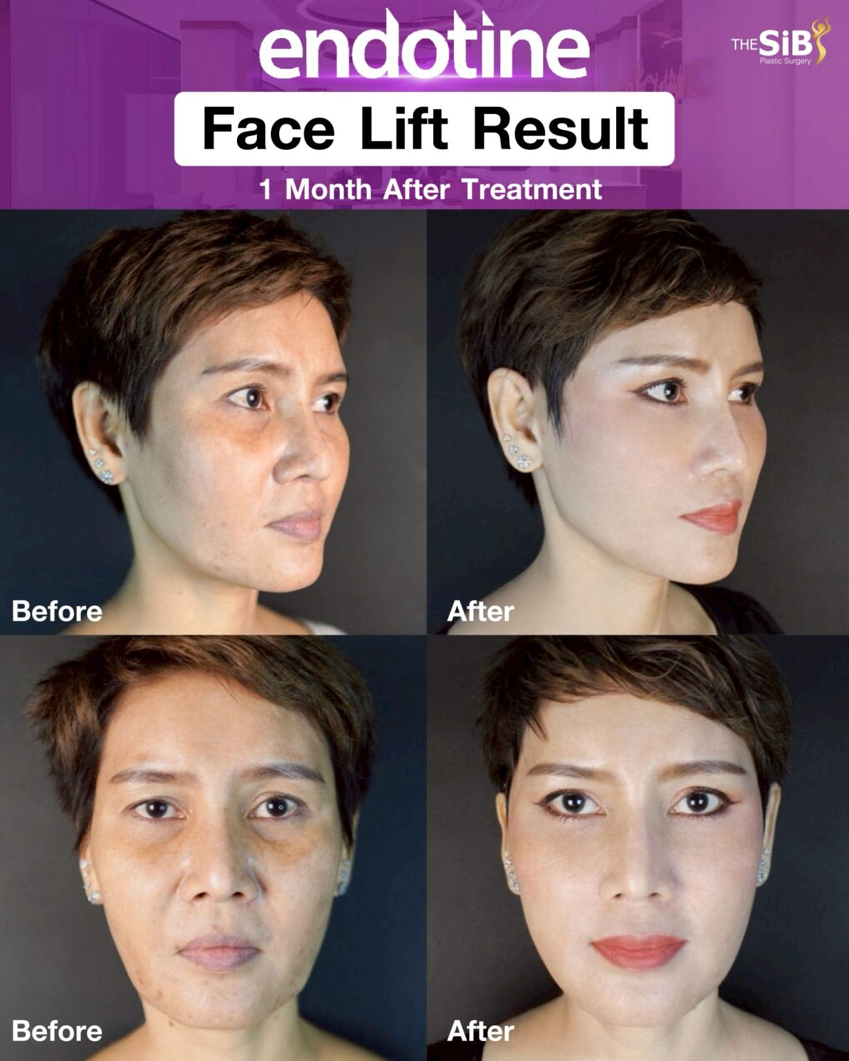 Endotine Face Lift Non-Surgical Facial Lifting – The SIB Plastic Surgery