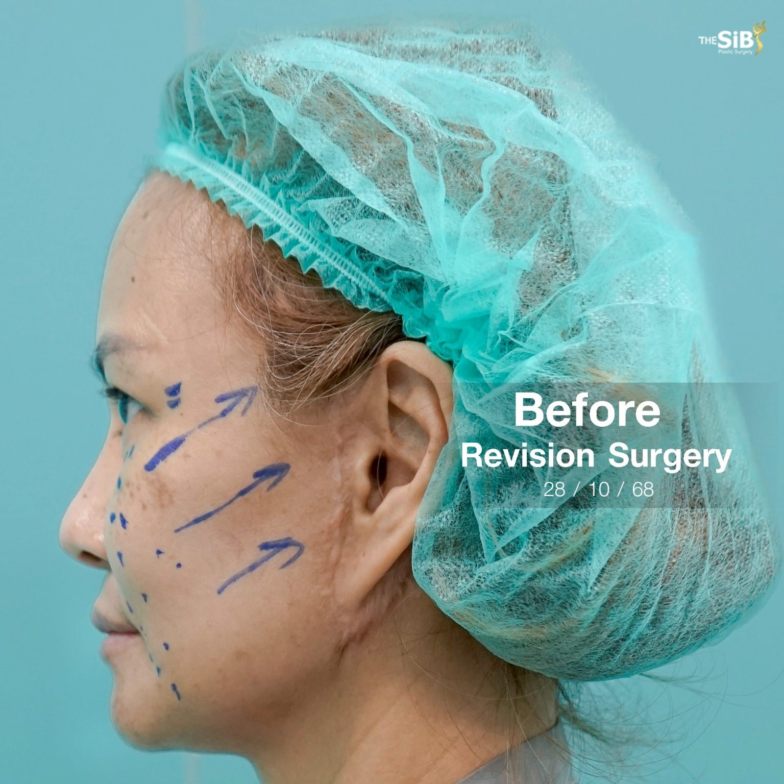 From an Unsatisfactory Result and Visible Scars – The SIB Plastic Surgery